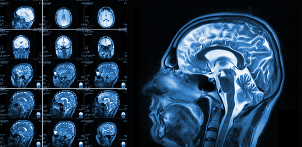 What Happens To Your Brain When You Give Up Sugar?